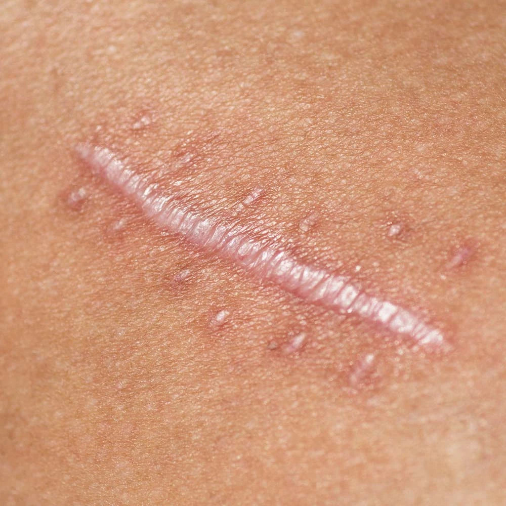 Scar Camouflage Tattoo Supplies USA | Professional Tools & Skin ...